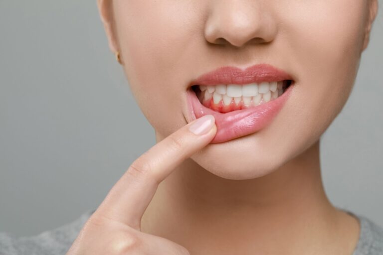 Dental Deficiency: What Causes Spongy Gums? | Rauchberg Dental Group